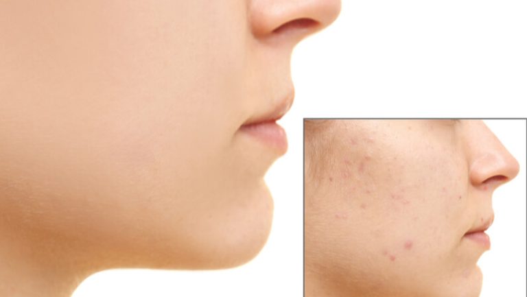 Acne Extraction: What You Need To Know | Skin Cancer Specialists New