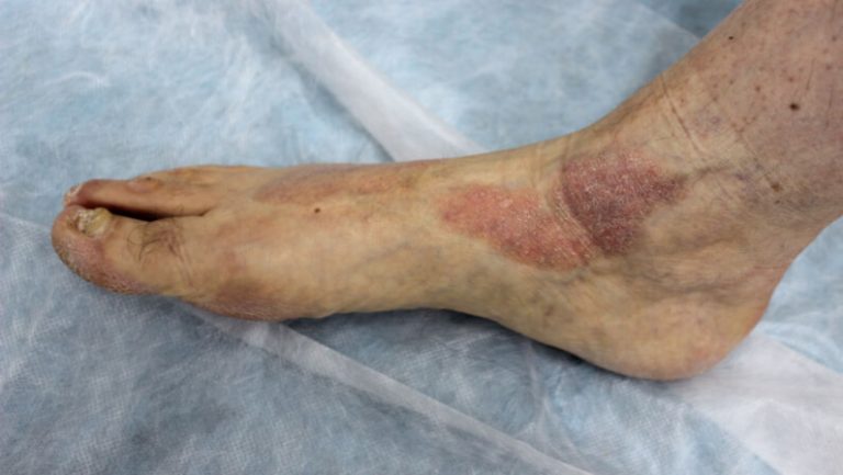 Understanding Lichen Simplex Chronicus: A Complete Guide