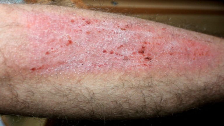 Understanding Lichen Simplex Chronicus: A Complete Guide