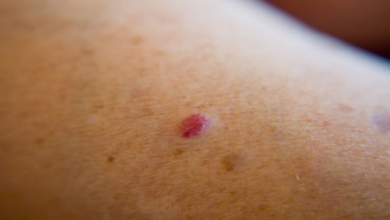 Causes of Cherry Angioma or Bright Red Spots on Skin
