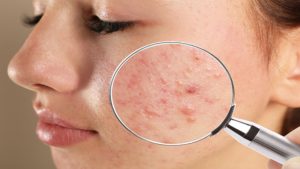 Pustule Symptoms & Treatment | Skin Cancer Specialists