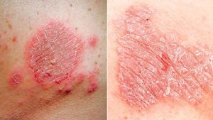 Difference Between Eczema and Psoriasis | Skin Cancer Specialists New