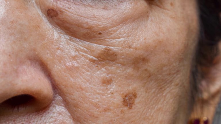 Dark Spots on Skin: Treatment Guide | Skin Cancer Specialists