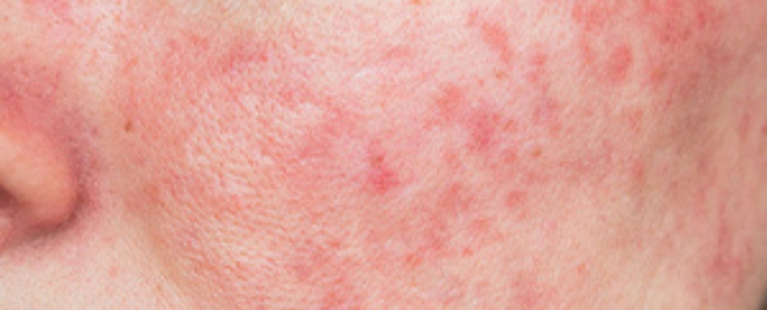 Blue Light & Skin Cancer: Does Screen Time Affect Your Skin?