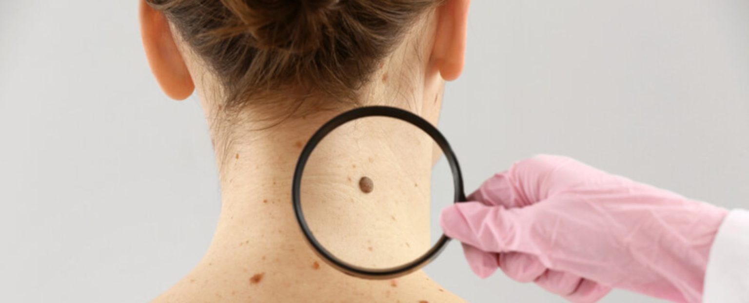 Melanoma 101: The Ultimate Guide to What You Should Know